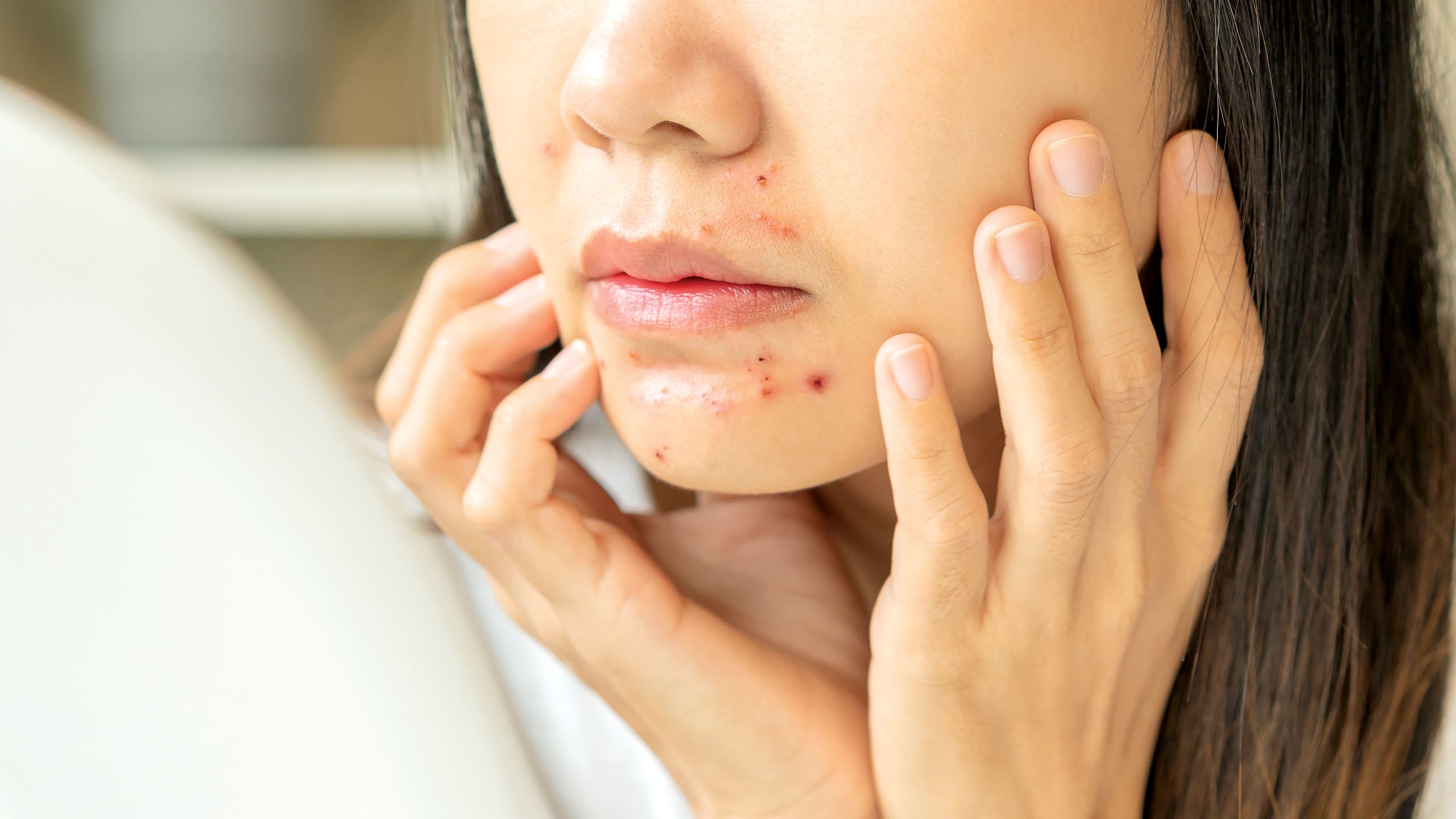 Acne in Your 40s? Let's Clear Things Up